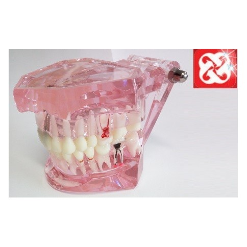 Tipodonto Dentición Mixta